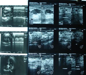 View USG.Breast - The Doctors Platform