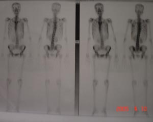View Bone scan - The Doctors Platform